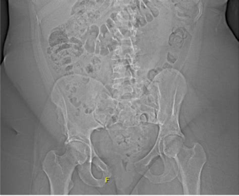 Diastatic And Asymmetric Pelvis In A Woman With Classic Bladder