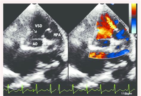 Transthoracic Echo In Short Axis View With Color Doppler Shows Large Download Scientific