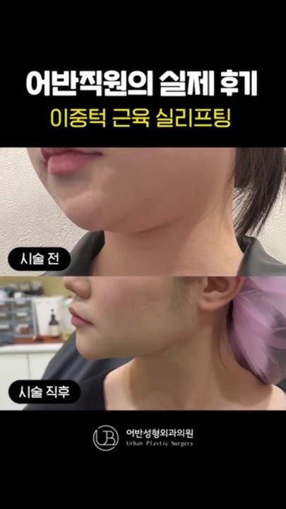 어반직원의 솔직후기 I 이중턱 근육 실리프팅 시술 Subscribe Shorts 이중턱리프팅 이중턱근육묶기 Youtube