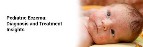 Pediatric Eczema Diagnosis And Treatment Insights