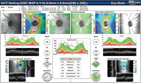Patient B Retinal Nerve Fiber Layer Rnfl In The First Days Of A Download Scientific Diagram