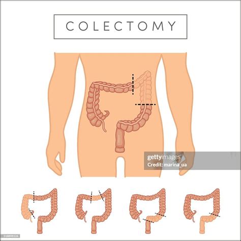 Types Of Colectomy High Res Vector Graphic Getty Images