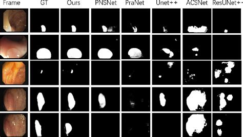 Figure From Polyp Segmentation Based On Boundary Supervision And Temporal Association