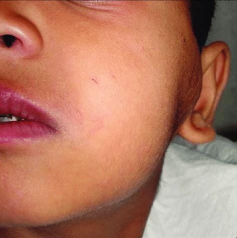 Extra Oral Photograph Revealed A Pre Auricular Swelling On The Left Download Scientific Diagram