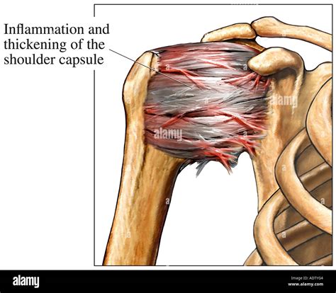 Adhesive Capsulitis