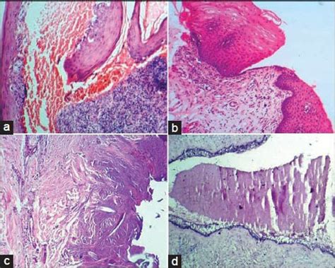 A Hemorrhage Artifact B Histopathological Section Showing Split Download Scientific