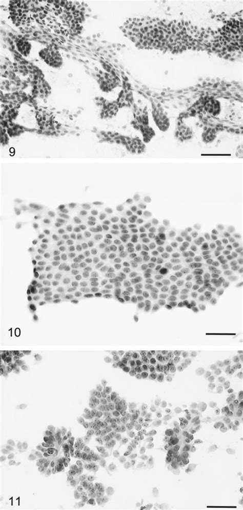 Brain Choroid Plexus Tumor Canine Low Magnification Of The Branching Download Scientific Brain Choroid Plexus Tumor Canine Low Magnification Of The Branching Download Scientific