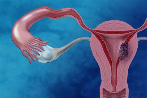 Endometrial Tumor Study Image Eurekalert Science News Releases