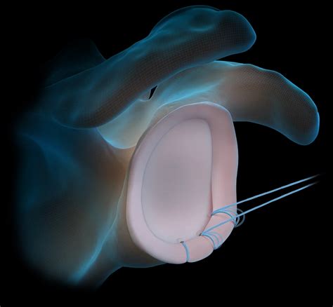 Arthroscopic Shoulder Stabilisation Dr Anton Lambers Orthopaedic