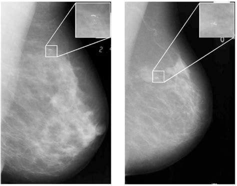 Figure 1 From Automatic Microcalcification And Cluster Detection For Digital And Digitised