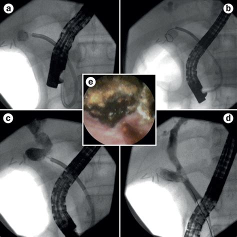 Percutaneous Cholangioscopy With Basket And Balloon Extraction Of Download Scientific Diagram