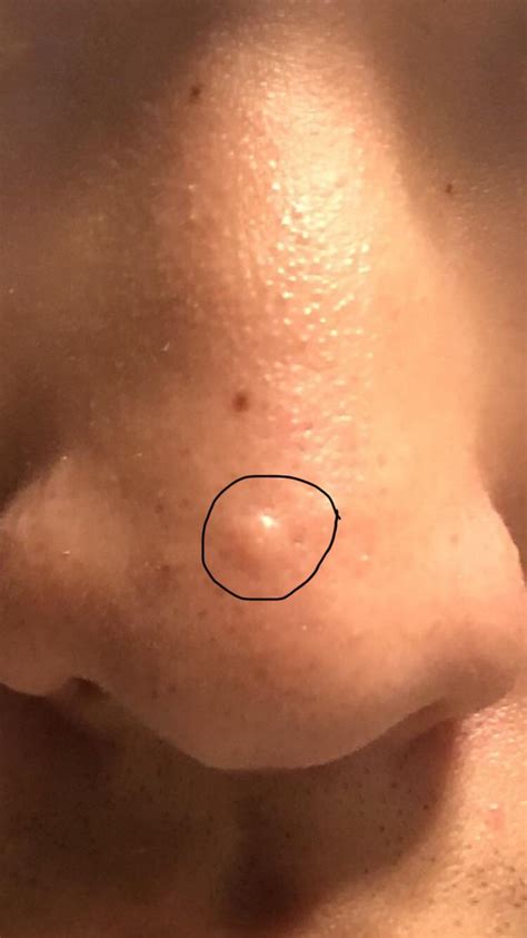 What Are Nose Bumps At Gail Carroll Blog