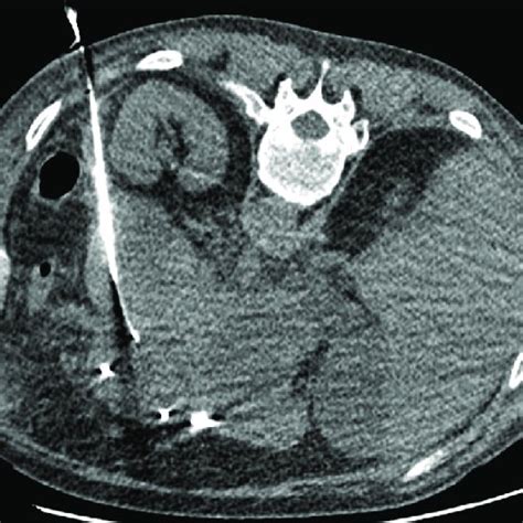 Ct Computed Tomography Guided Drainage Of Peripancreatic Collection Download Scientific