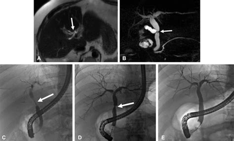Imaging Of Ischemic Cholangiopathy Following Donation After Circulatory Death Liver Transplant