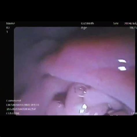 Dr Sharan Malipatil Mbbs Md Dm On Linkedin Referred Case Distal Cbd Stricture Failed