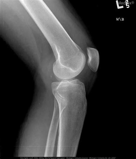 Cpt Code 20600 20610 20605 Arthrocentesis Cpt Codes Cpt Code 20600 20610 20605 Arthrocentesis Cpt Codes