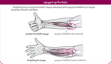 იდაყვის ტრავმები მკურნალი გე