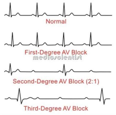 Second Degree Av Block Types