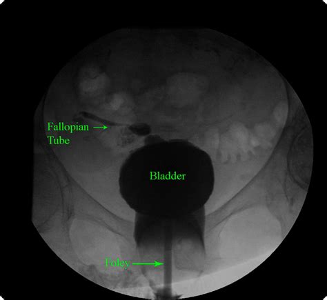 A Problematic Pathway American Journal Of Obstetrics Gynecology