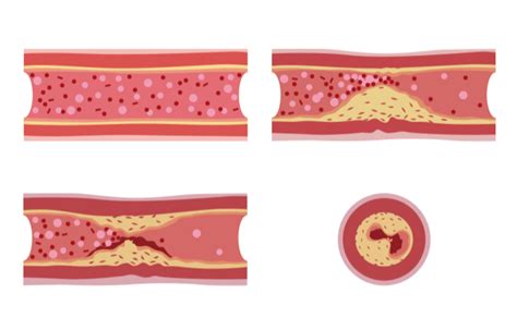 콜레스테롤 뜻 Hdl Ldl 차이점 수치 검사