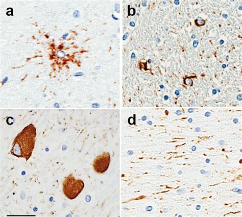 tau immunoreactive lesions in psp characteristic phosphorylated download scientific diagram