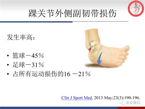 踝关节外侧副韧带损伤的诊断与治疗 上海开为医药科技有限公司 创伤、肢体矫形技术解决方案的专业服务商