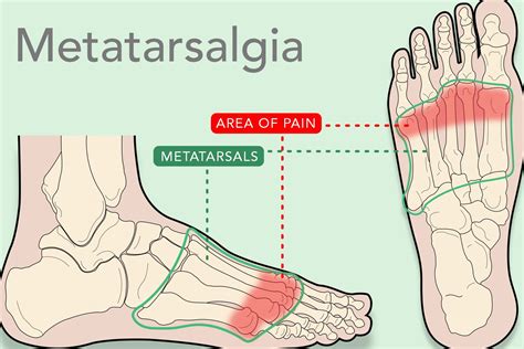 Podiatrist In Sturgis Metatarsalgia In Sturgis Advanas Foot And Ankle