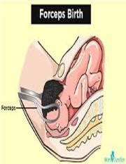 Forceps Delivery Pptpptxpdf Forceps Assisted Birthdelivery A