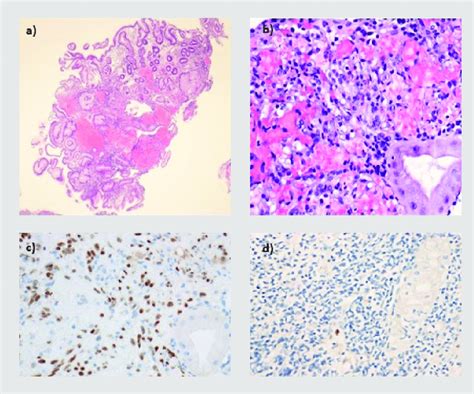 Microscopic Findings Of Gastric Biopsies A Hyperplasic And Ulcerated Download Scientific