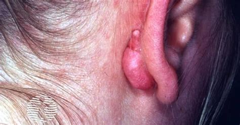 Dermnet® Keloid Image