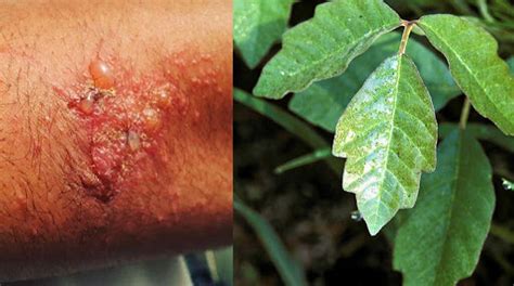 Discover Poison Oak Rash Symptoms And Remedies With Umedoc Umedoc Telehealth Platform