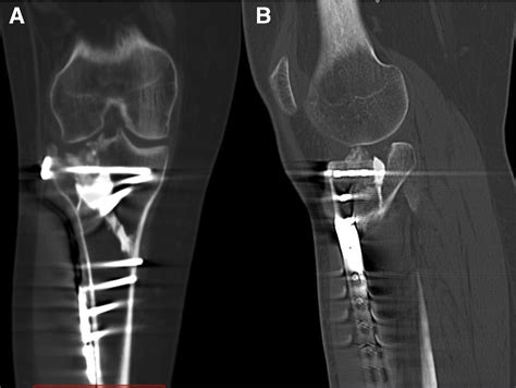 Figure 1 From Osteochondral Proximal Tibial And Lateral Meniscal Allograft Transplant
