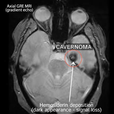 Neurological System Glossary Cavernoma Aka Cerebral Cavernous