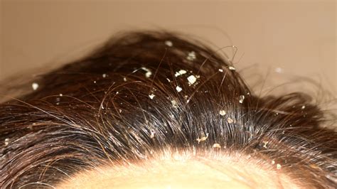 Dandruff Vs Dry Scalp Are You Using The Right Shampoo