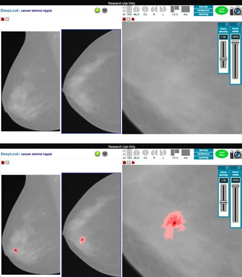 Another Malignant Mass Revealed In Dense Breast Tissue Top Image