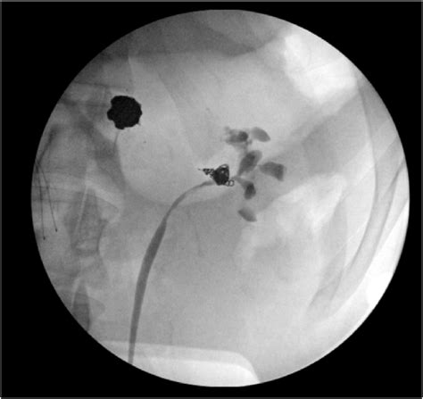 Left Retrograde Pyelogram With Resolved Fistula Left Retrograde