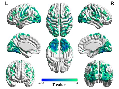 Reduced Interhemispheric Functional Connectivity In Obsessive Compulsive Disorder Patients