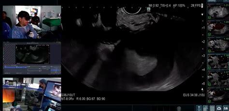 Advancements In Endoscopic Techniques Endoscopy On Air