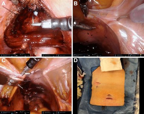 Intraoperative Images During Sp Rs Ralp A Anterior Anastomosis Is Download Scientific Diagram