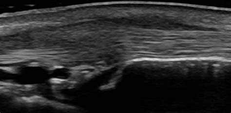 Musculoskeletal Joints And Tendons 6 3 Wrist And Carpus Case 6 3 1 Tenosynovitis Of The