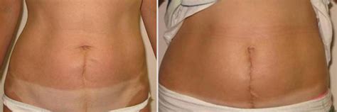 C Section Scar Tissue Release Therapy Cesarean Scar Massage