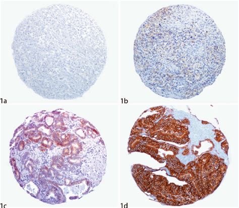 Figure 1 From Her2 Neu Testing In Gastric Cancer By Immunohistochemistry Assessment Of