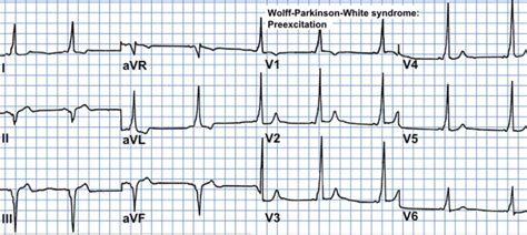 Surface 12 Lead Ecg In A Patient With Wpw Syndrome The Ecg Showed Download Scientific Diagram
