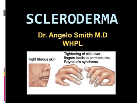Scleroderma