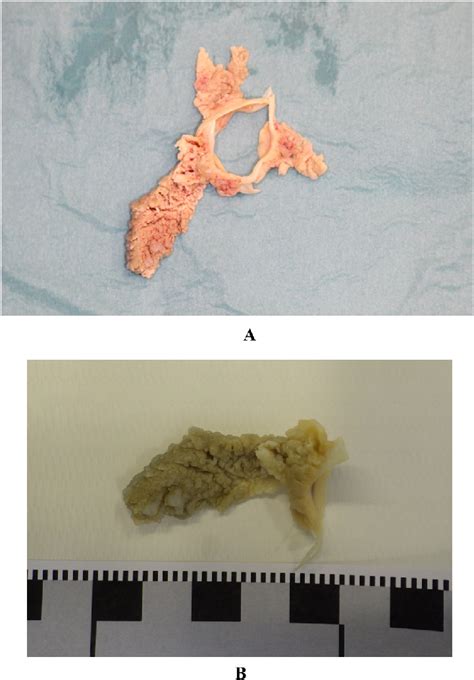 A Picture Of Excised Valve In The Operating Theater With Involvement Download Scientific