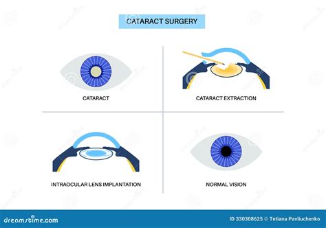 Cataract Surgery Poster Cartoon Vector 330308625