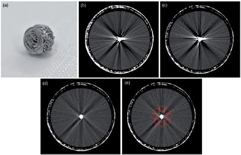 Figure 1 From Usefulness Of Monochromatic Imaging With Metal Artifact Reduction Software For