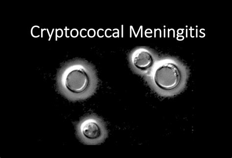 Cryptococcal Meningitis Ed Presentations Evaluation And Management