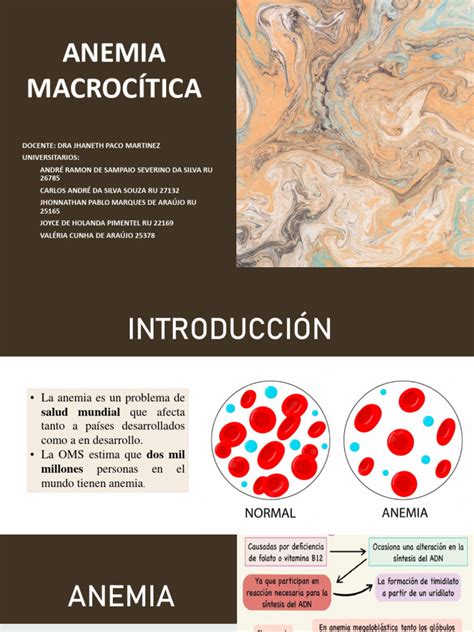 Anemia Macrocítica Pdf Anemia Especialidades Medicas