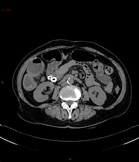 Delayed Diagnosis Of Enterolithiasis In Crohns Disease Eurorad